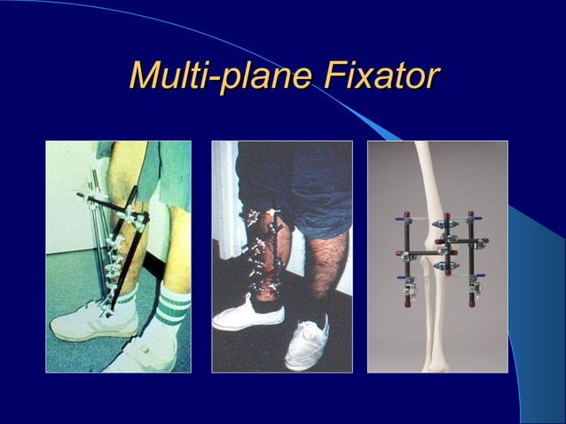 (9)external fixation indications and techniques(bonatus) | PPT | First ...