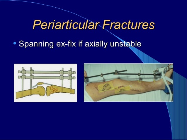 (9)external fixation indications and techniques(bonatus)
