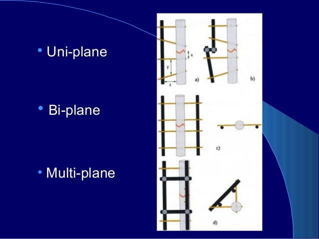 (9)external fixation indications and techniques(bonatus)