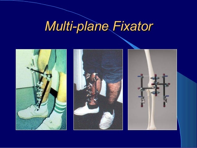 (9)external fixation indications and techniques(bonatus)