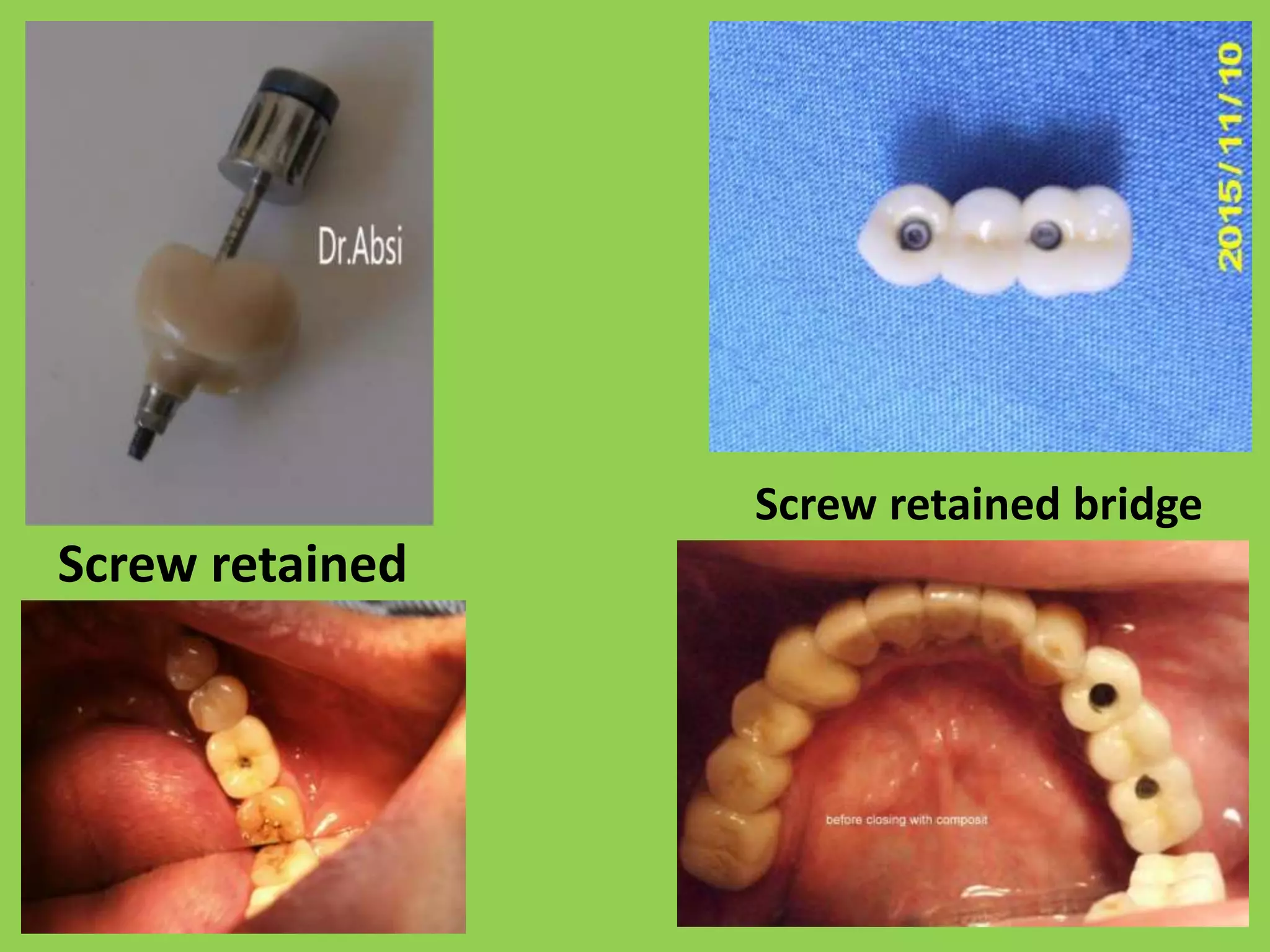 My first screw retained | PPTX