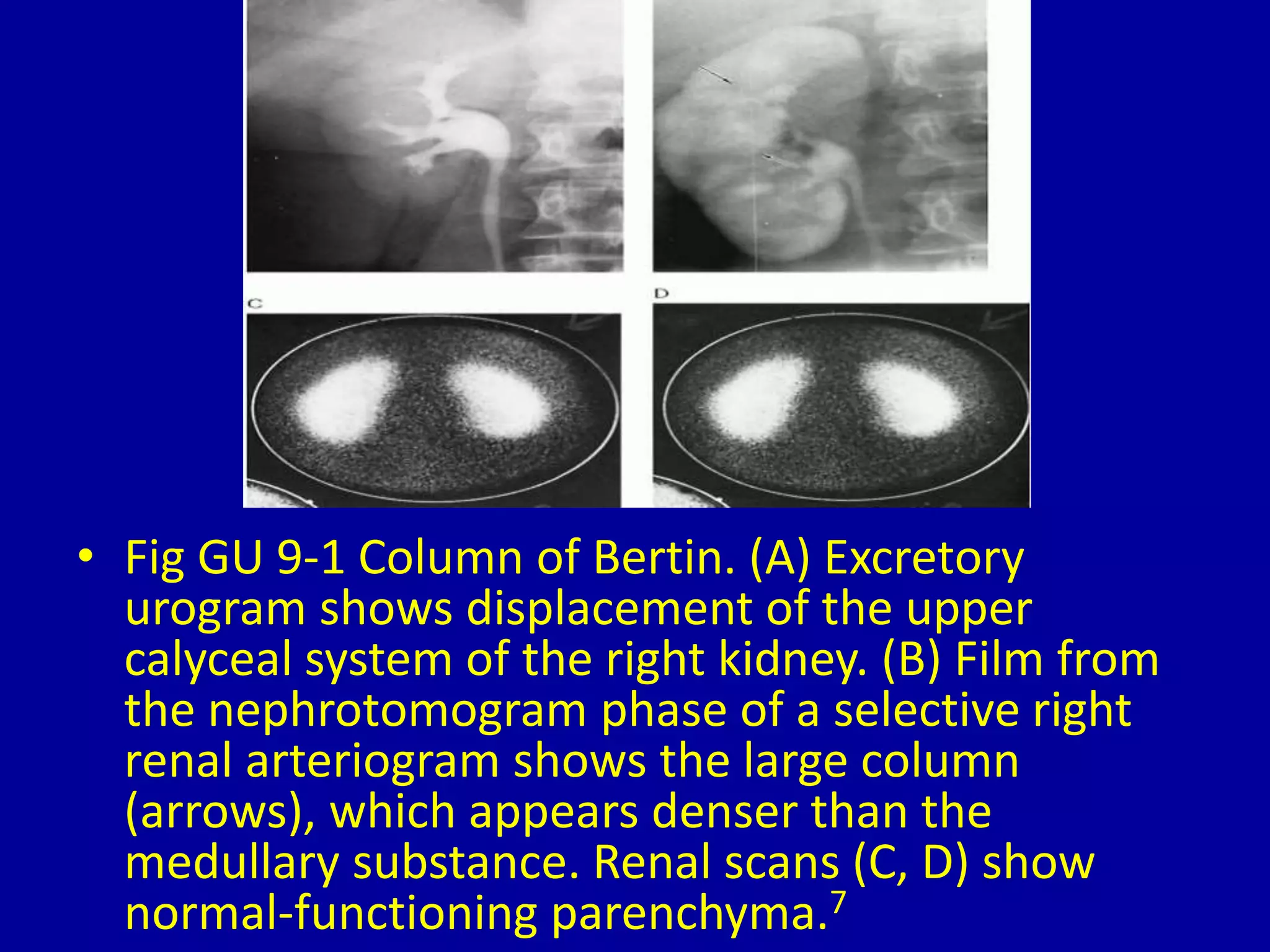 9 focal renal mass | PPTX