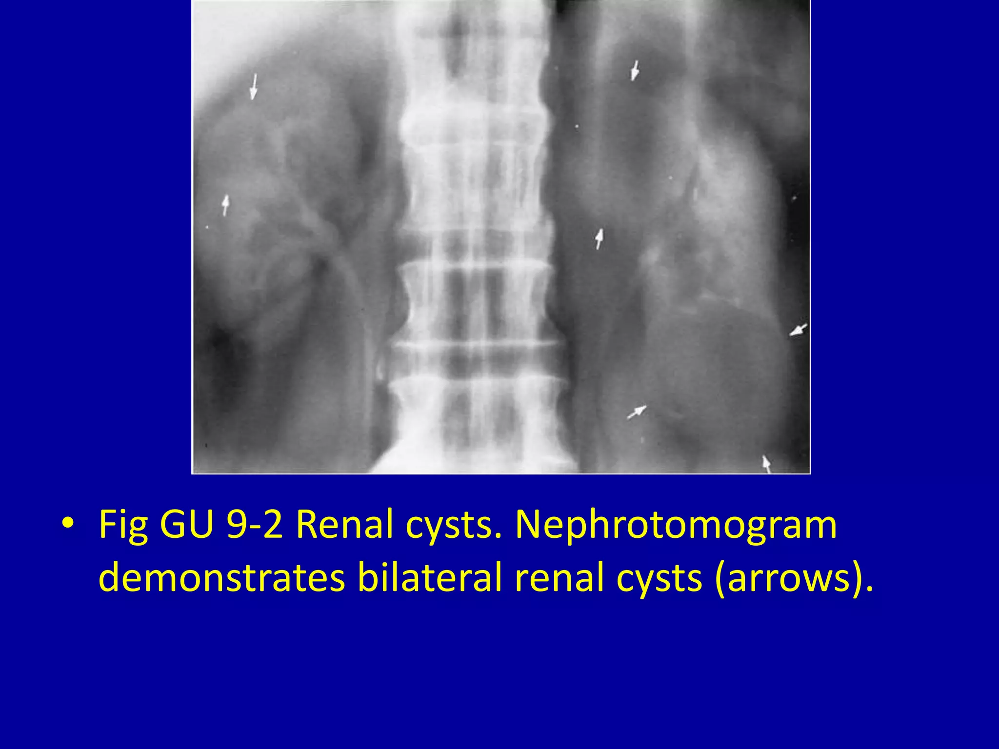 9 focal renal mass | PPTX