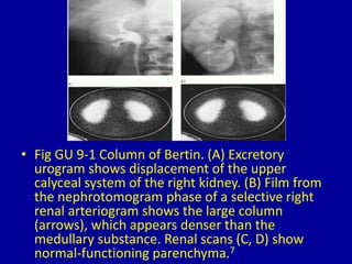 9 focal renal mass | PPT