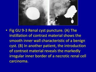 9 focal renal mass | PPT