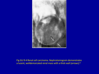 9 focal renal mass | PPT