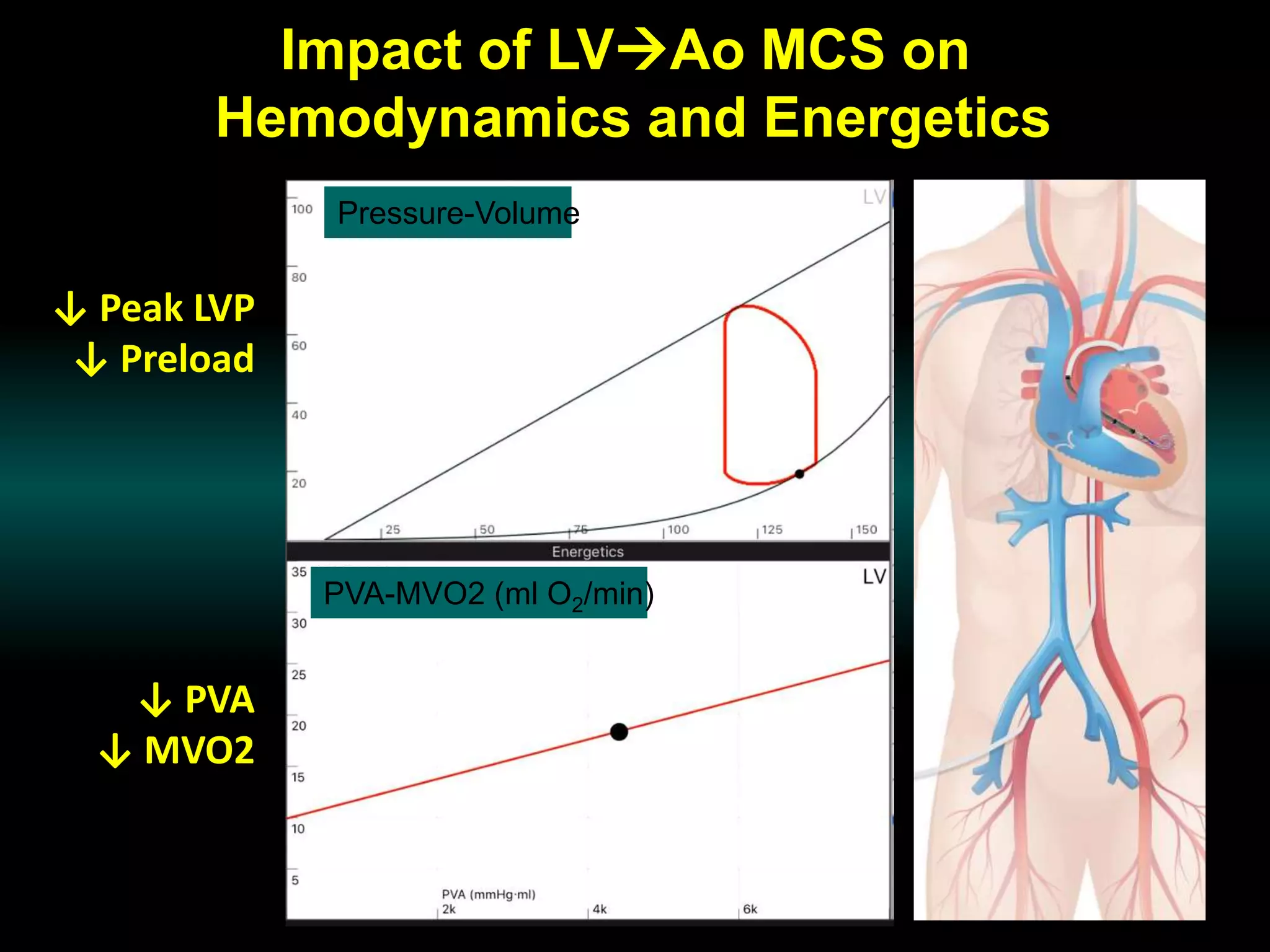 PCI & AimRadial 2018 | Treating Cardiogenic Shock with Impella with ...