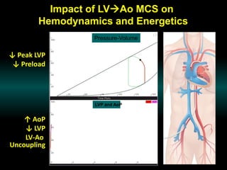 PCI & AimRadial 2018 | Treating Cardiogenic Shock with Impella with Escalation to ECMO - Ramon ...
