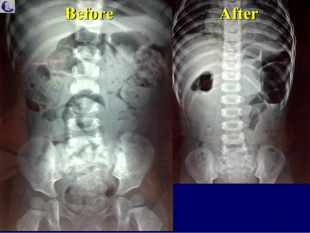 Constipation in Infants & Children