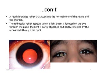 9 pediatric opththalmology leukocoria tt.pptx