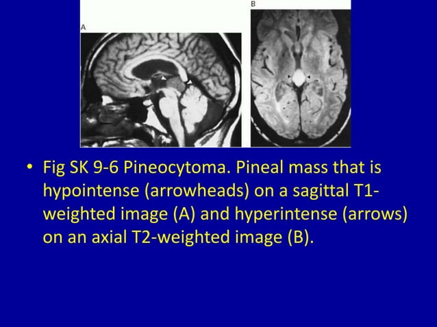 9 masses in the pineal region | PPTX | Brain and Nervous System ...