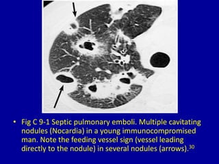 9 multiple pulmonary nodules on computed tomography | PPTX