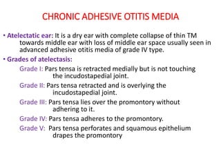NONSUPPURATIVE OTITIS MEDIA | PPTX