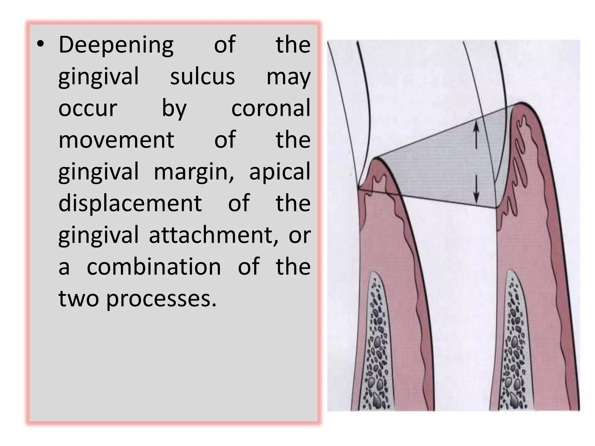 Periodontal pocket | PPTX