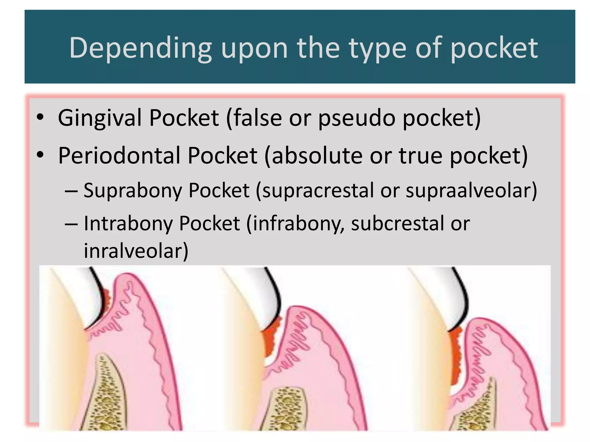 Periodontal pocket | PPTX