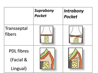 Periodontal pocket | PPT