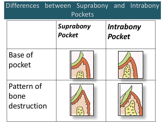 Periodontal pocket