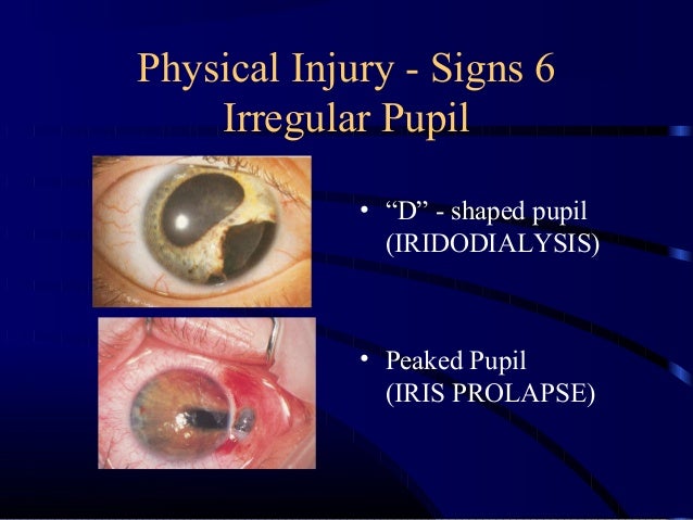 Irregular Pupil Medical Term