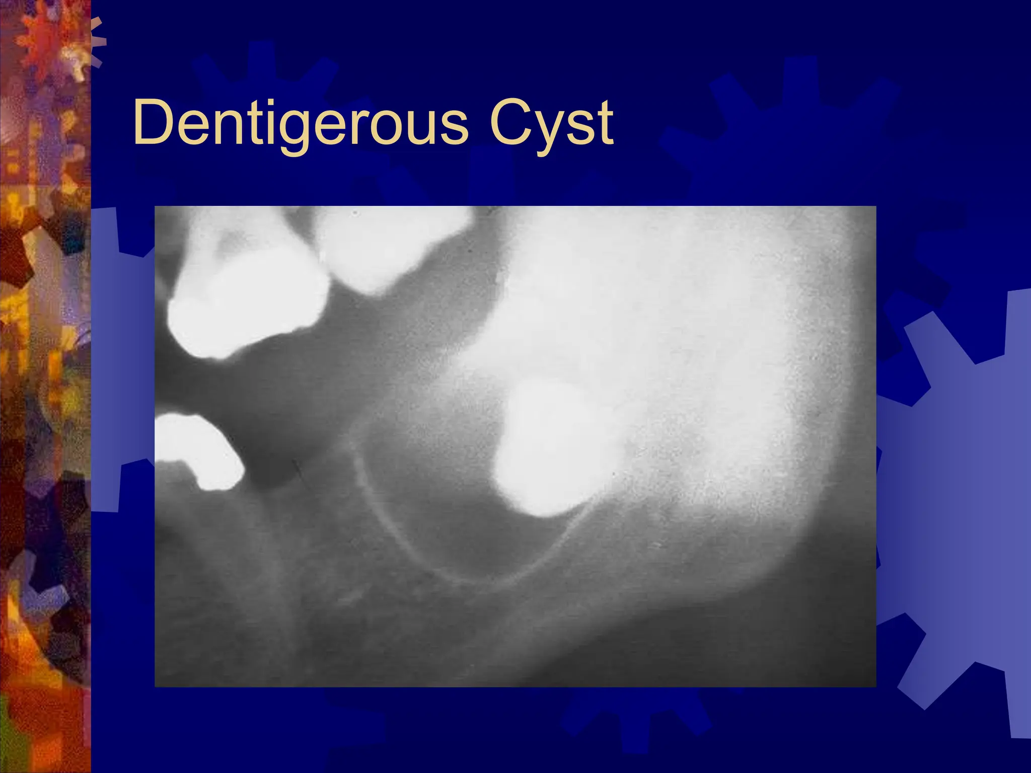 Benign odontogenic tumours of the oral cavity | PPT