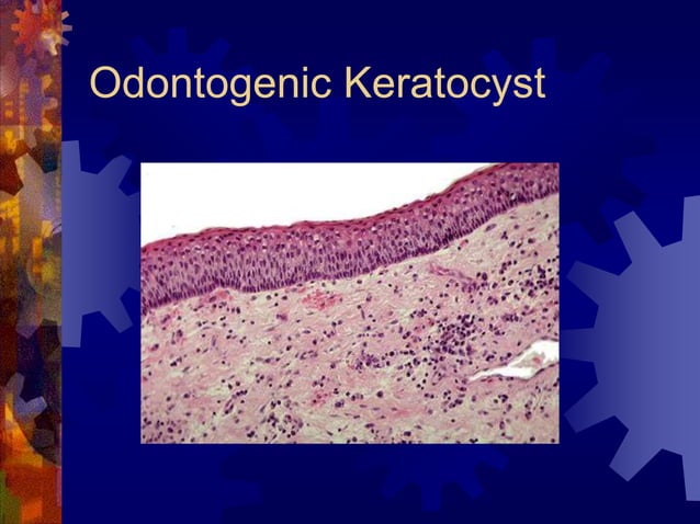 Benign odontogenic tumours of the oral cavity | PPT