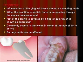 9periodontitis | PPT | Ear, Nose and Throat Conditions | Diseases and ...