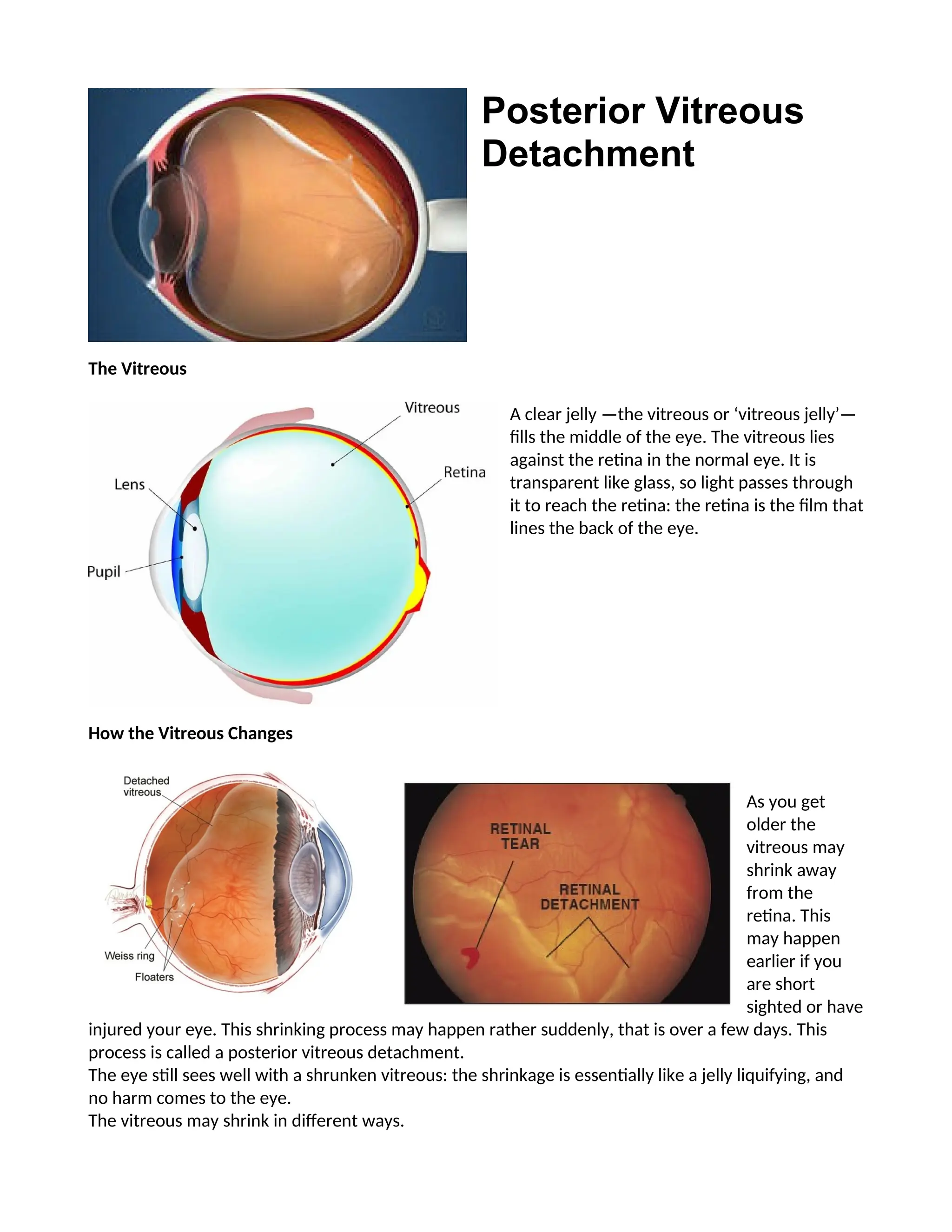 9Posterior Vitreous Detachment patient education | DOCX