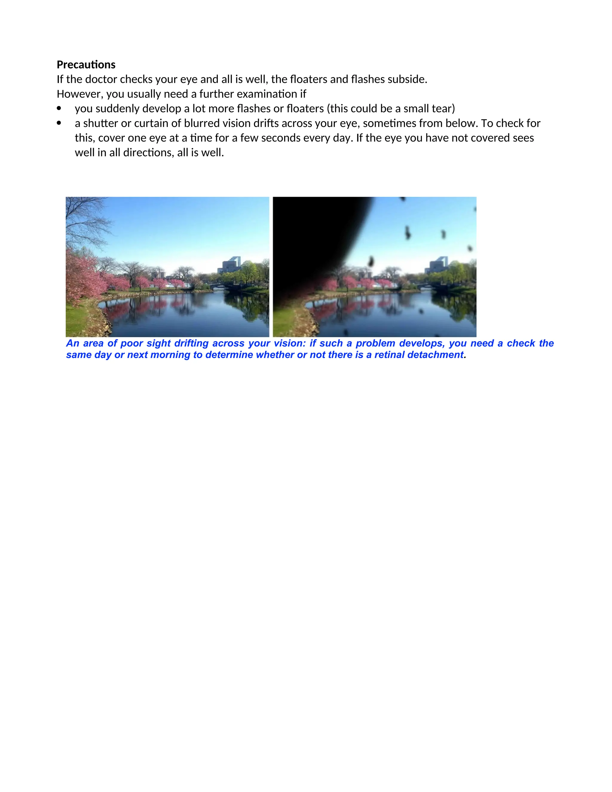 9Posterior Vitreous Detachment patient education | DOCX