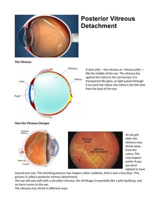 9Posterior Vitreous Detachment patient education | DOCX