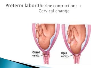 preterm labor | PPT
