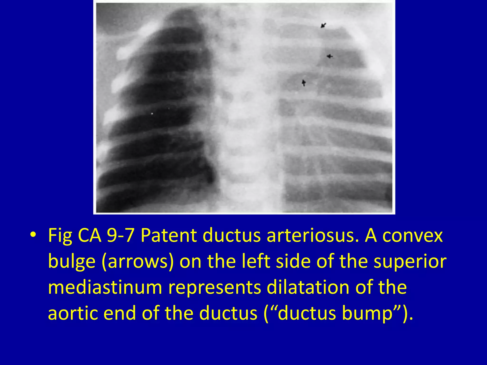 9 prominent ascending aorta or aortic arch | PPTX