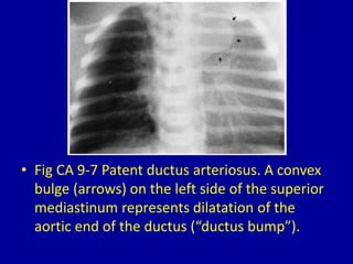 9 prominent ascending aorta or aortic arch | PPTX