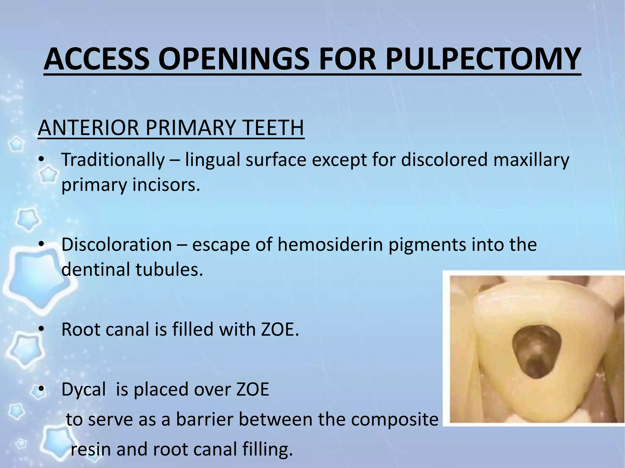 Pulpectomy | PPTX