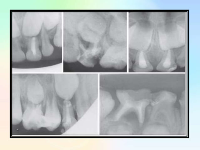 Pulpectomy | PPTX | Dental Health | Diseases and Conditions