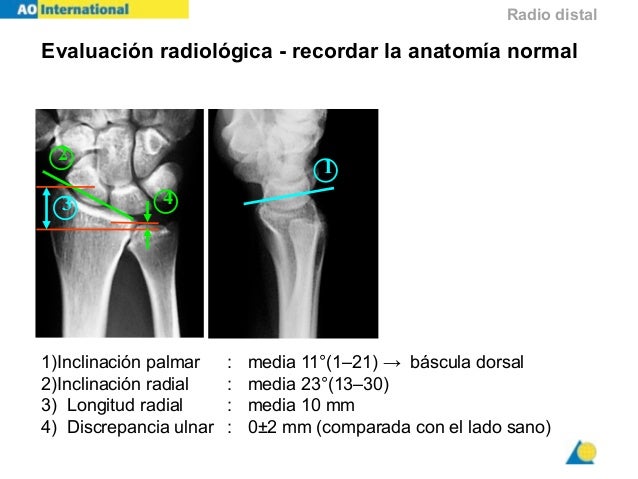 9 radio distal ao Dr Miguel Mite
