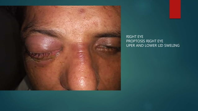 CASE PRESENTATION ON ORBITAL CELLULITIS | PPTX