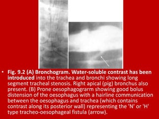 9 the paediatric chest | PPTX | Lung and Respiratory Health | Diseases ...