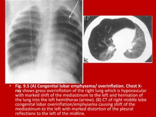 9 the paediatric chest | PPTX