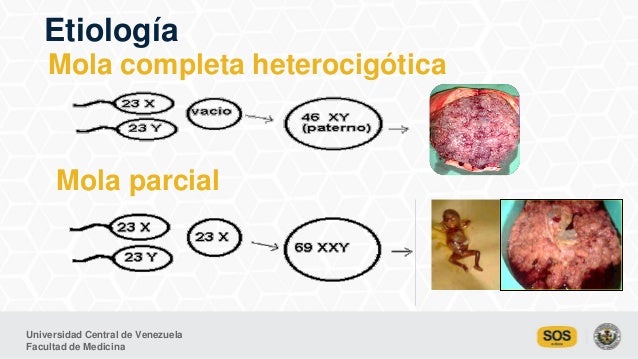 Embarazo Molar. Dr. Rafael Cortés Charry