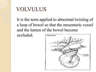 volvulus by alam zeb amir | PPTX