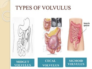 volvulus by alam zeb amir | PPTX