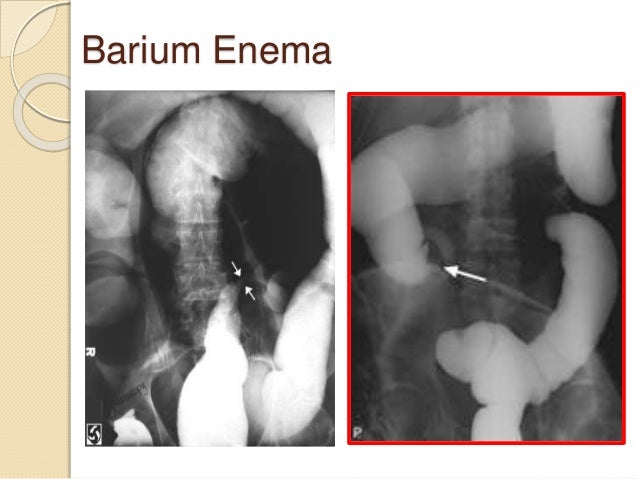 volvulus by alam zeb amir