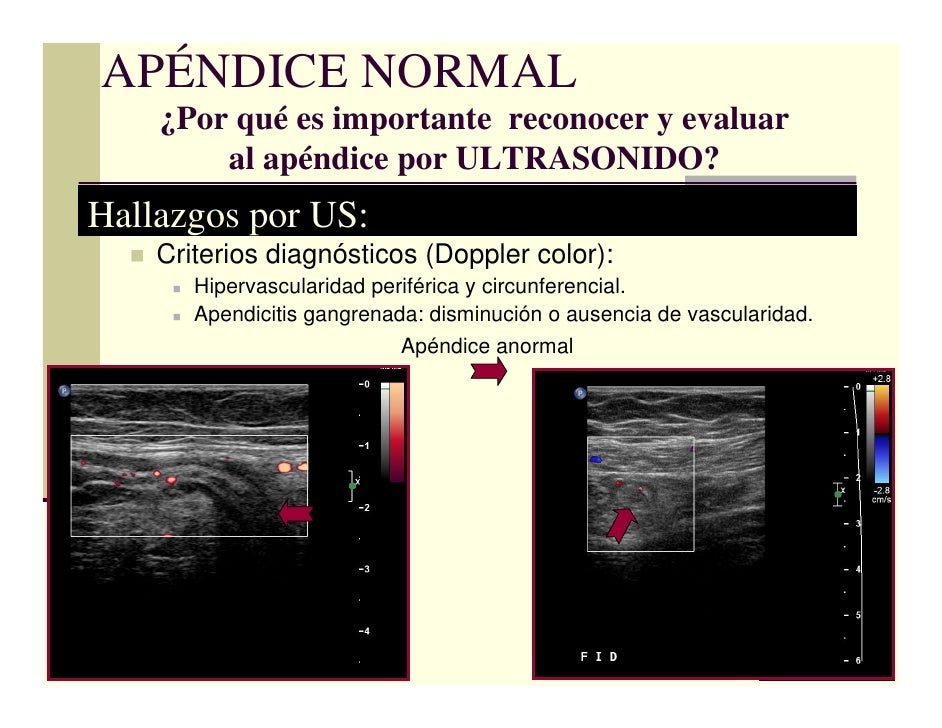 Ultrassonografia De Apendice Normal