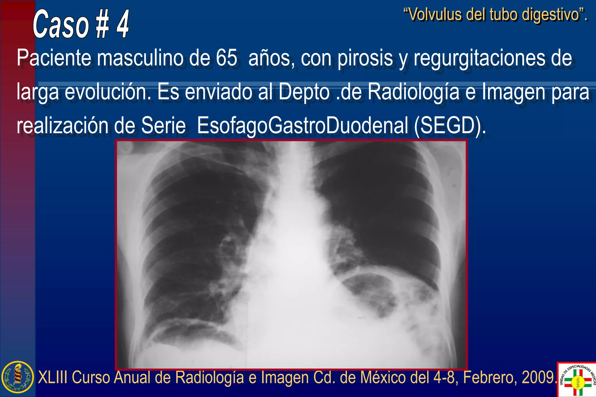 Vólvulo tubo digestivo estudios radiológicos simples contrastados TCMD ...