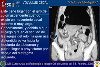 Vólvulo tubo digestivo estudios radiológicos simples contrastados TCMD ...