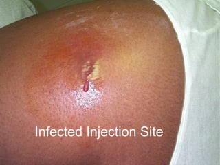 Cannula And Infection | PPS | Infectious Diseases | Diseases and Conditions