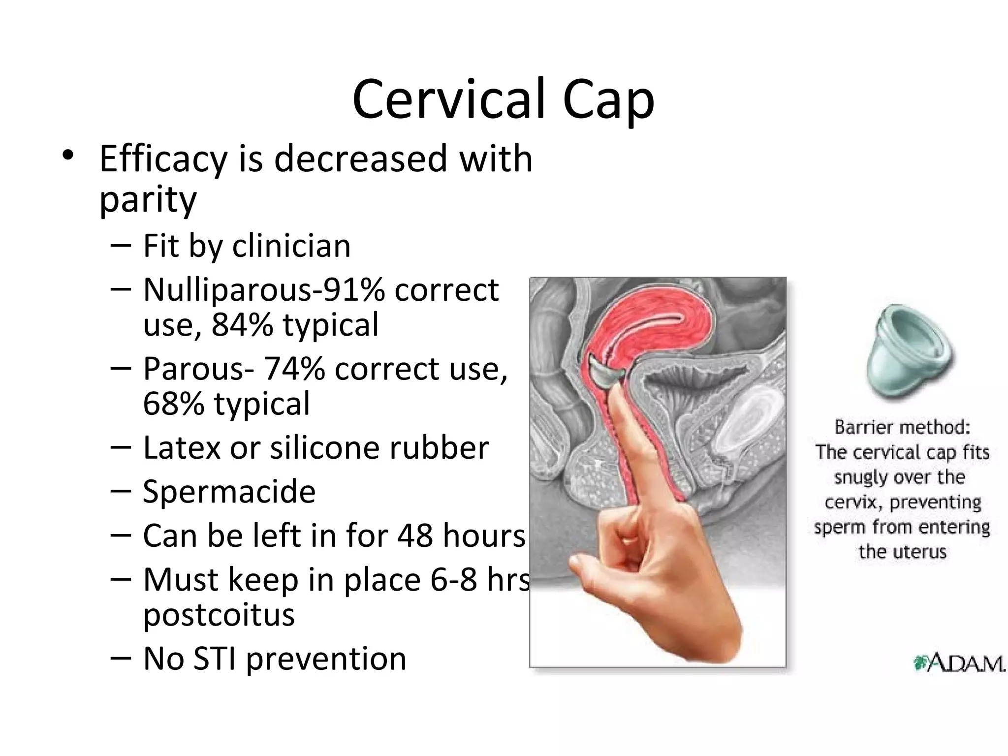 Methods of Contraception | PPT