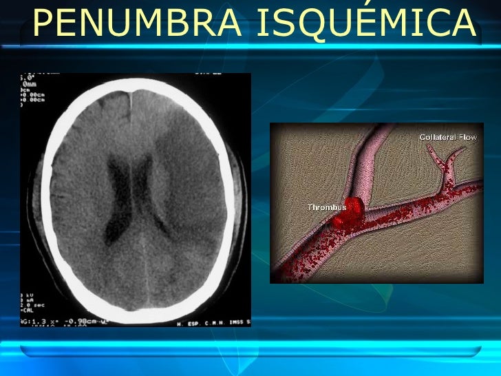 Enfermedad Vascular Cerebral