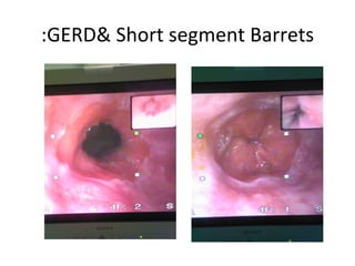 Git Endoscopy Pics 23209. | PPT