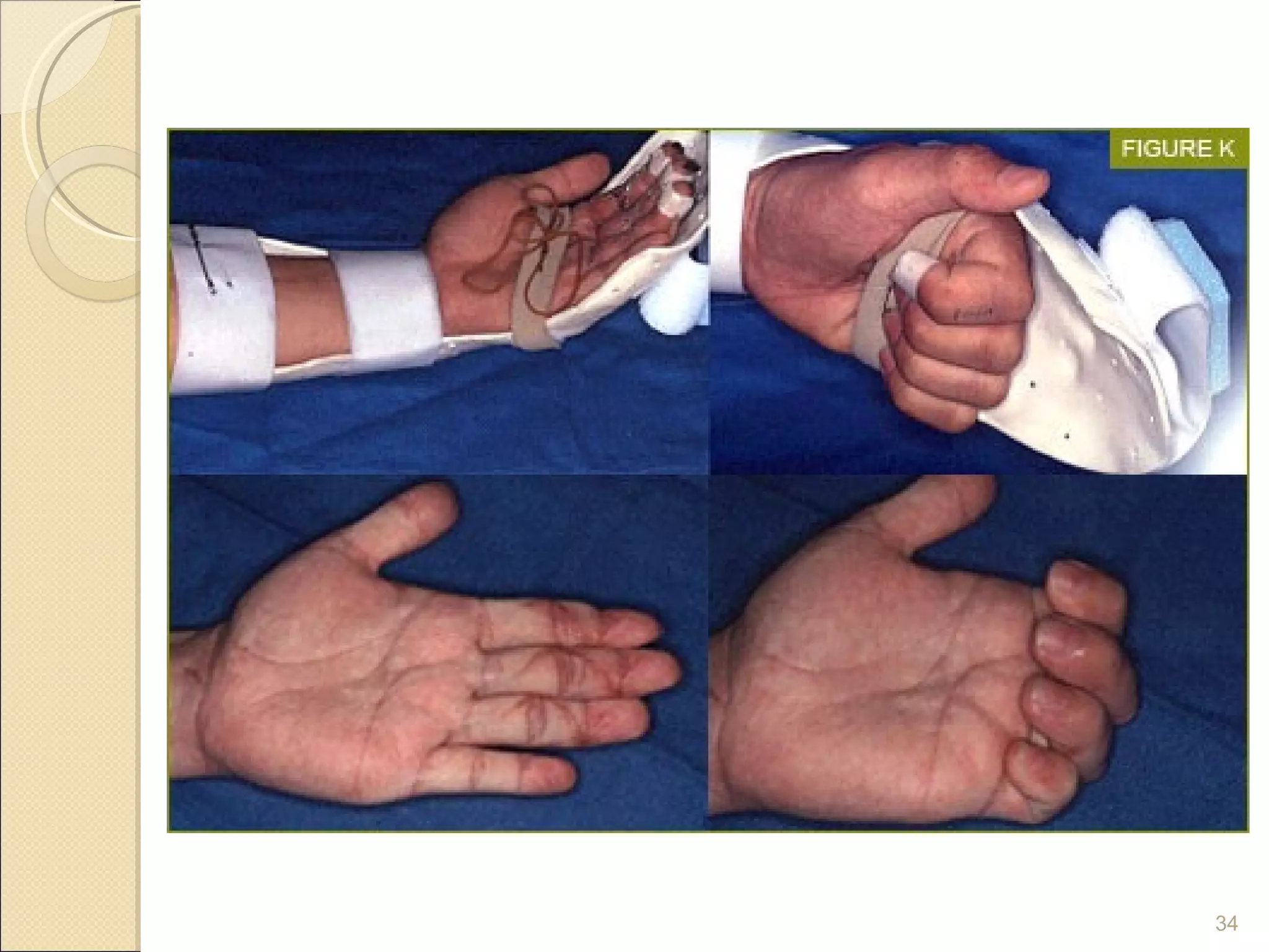 Hand Trauma | PPT