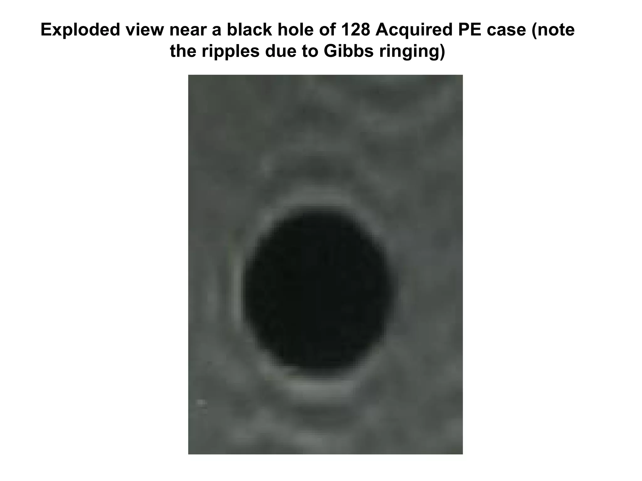 Mri Gibbs Ringing Artifact Reduction | PPT
